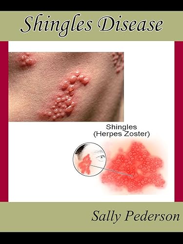 Shingles Disease - The Complete Guide - Everything you need to know about Shingles Disease; from ...