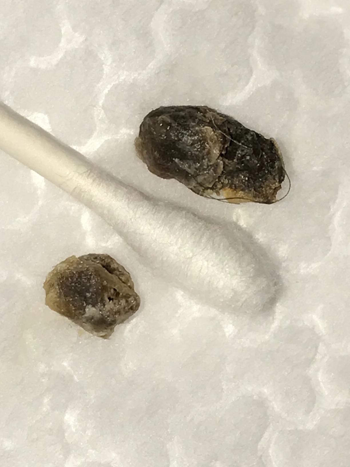 Amazing!! Great for removing impacted, hard ear wax!!