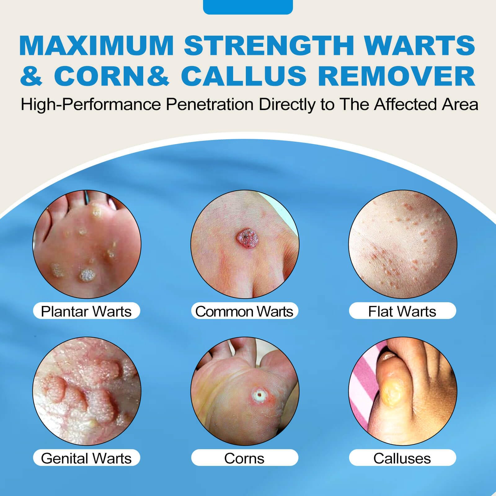 Mua Super-Skin Wart Remover, Maximum Strength Salicylic Acid Liquid ...