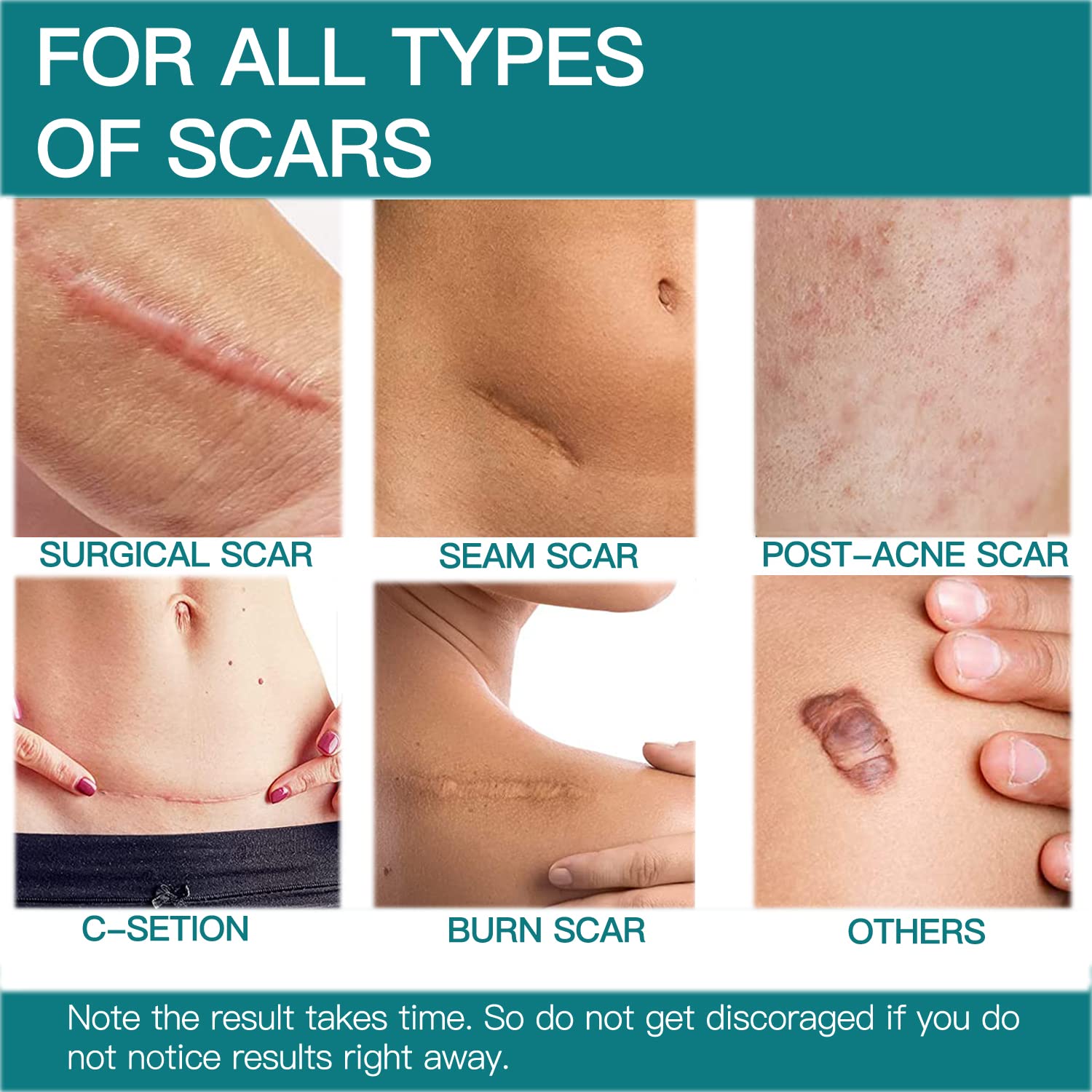 Mua Upgrade Silicone Scar Sheets (1.6" x 120"- 3 Meter), Medical Grade ...