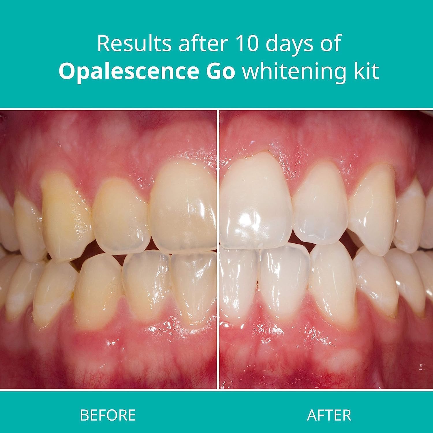 Mua Opalescence Go 15- Prefilled Teeth Whitening Trays - 15% Hydrogen ...