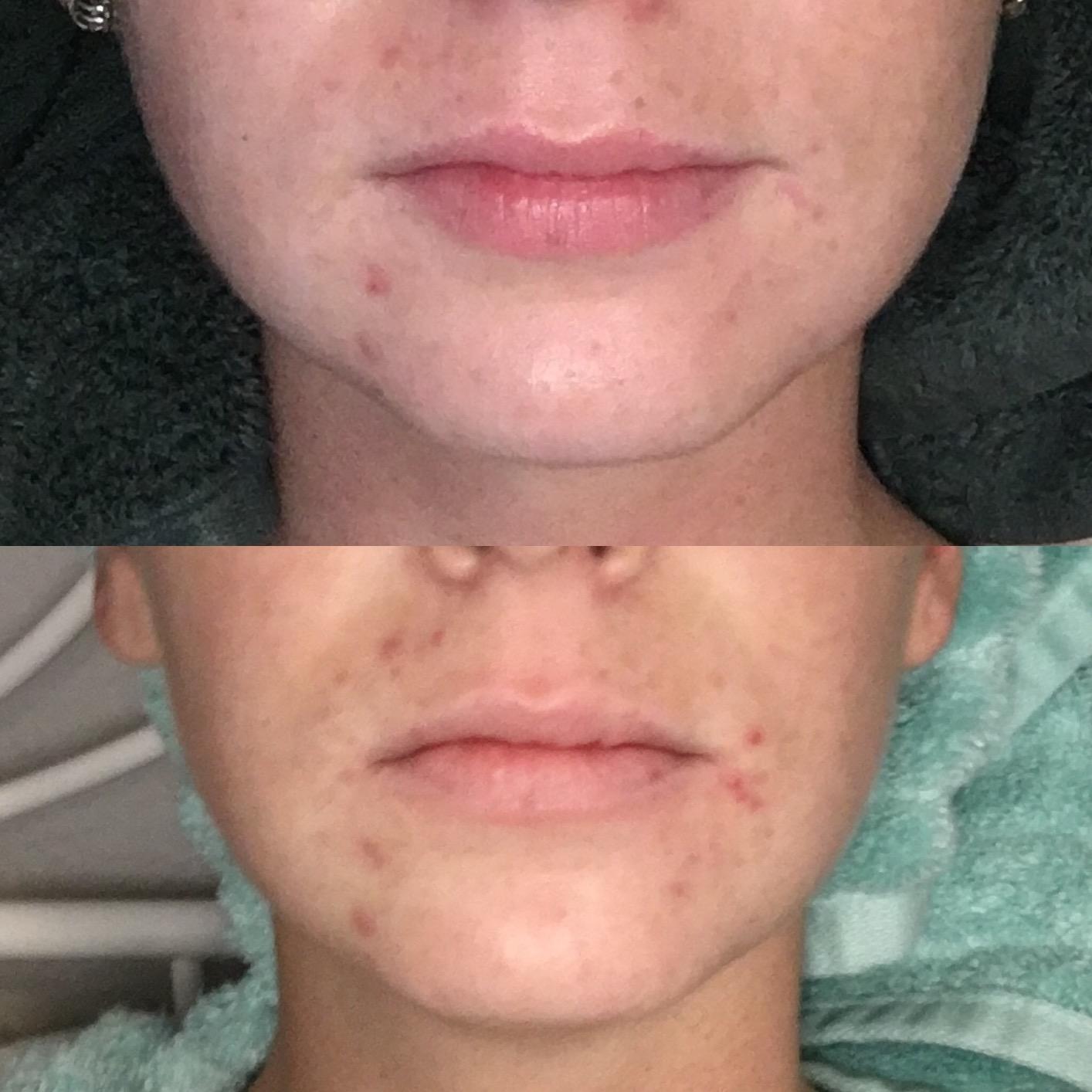 $5/mo - Finance Mario Badescu Anti Acne Serum for Combination & Oily ...