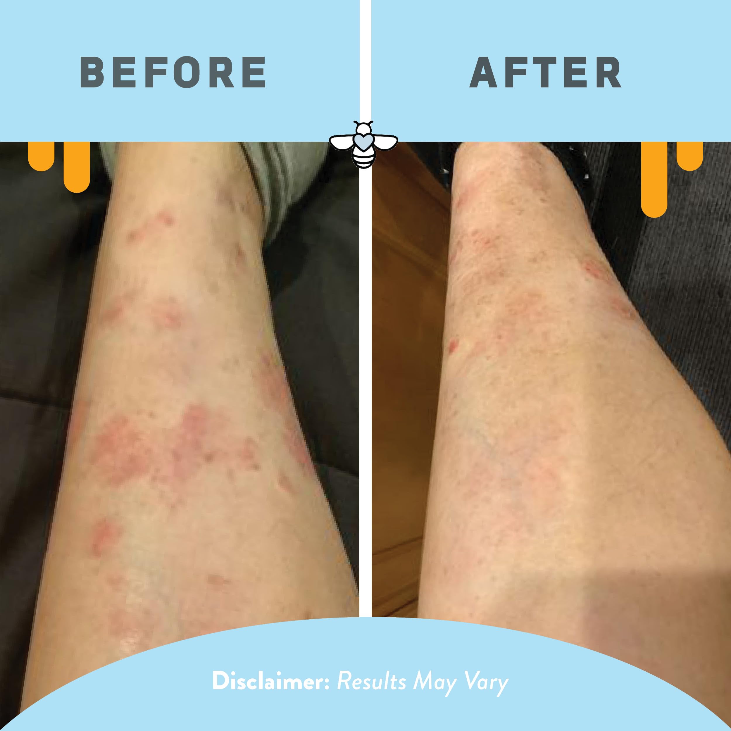 Mua Daily Moisturizing Body Lotion - Eczema & Seborrheic Dermatitis ...