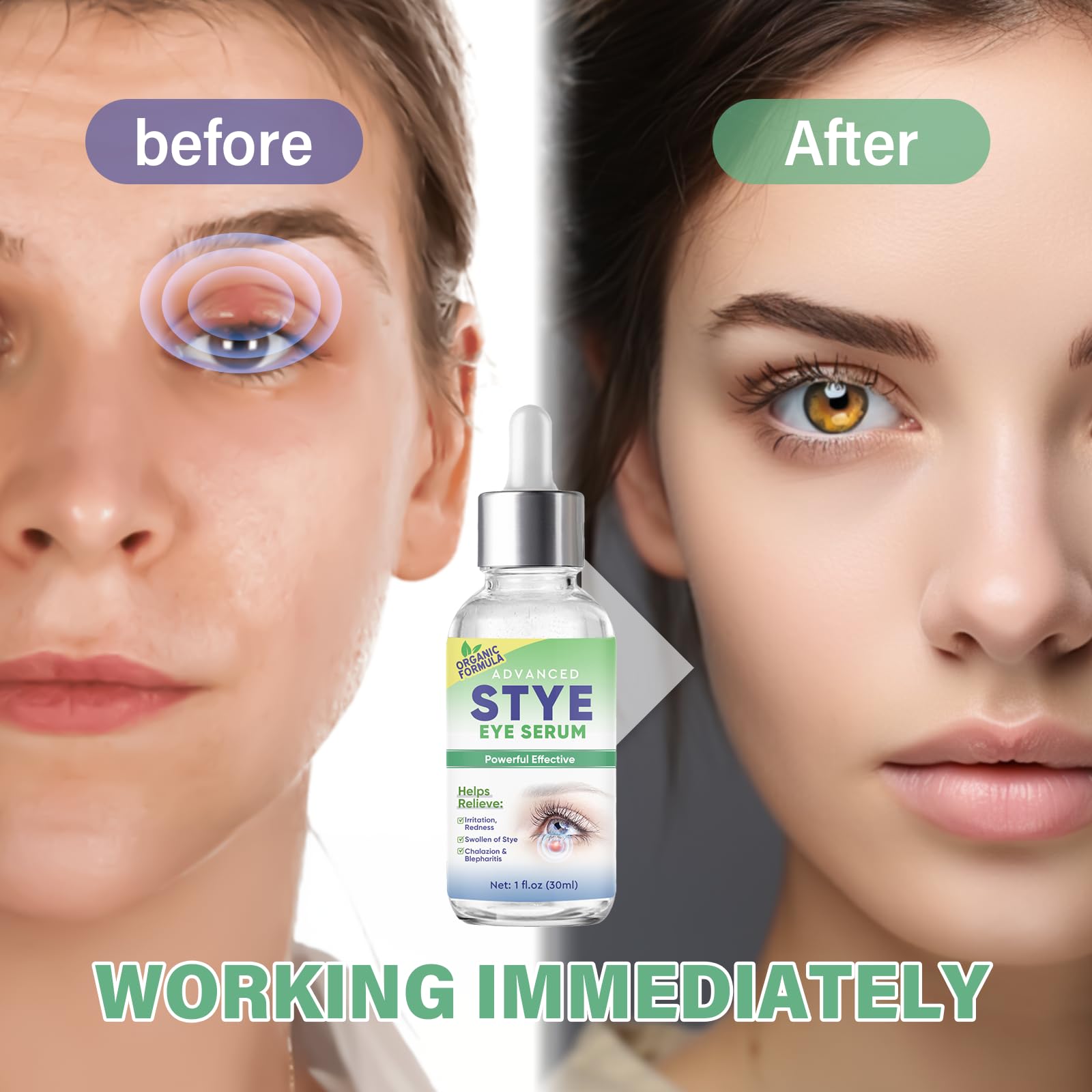 Mua Stye Eye Treatment, Natural Stye Eye Serum for Styes Chalazion and ...