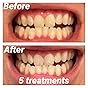 Amazon.com: Smile Titan Teeth Whitening Kit, 35% Carbamide Peroxide ...