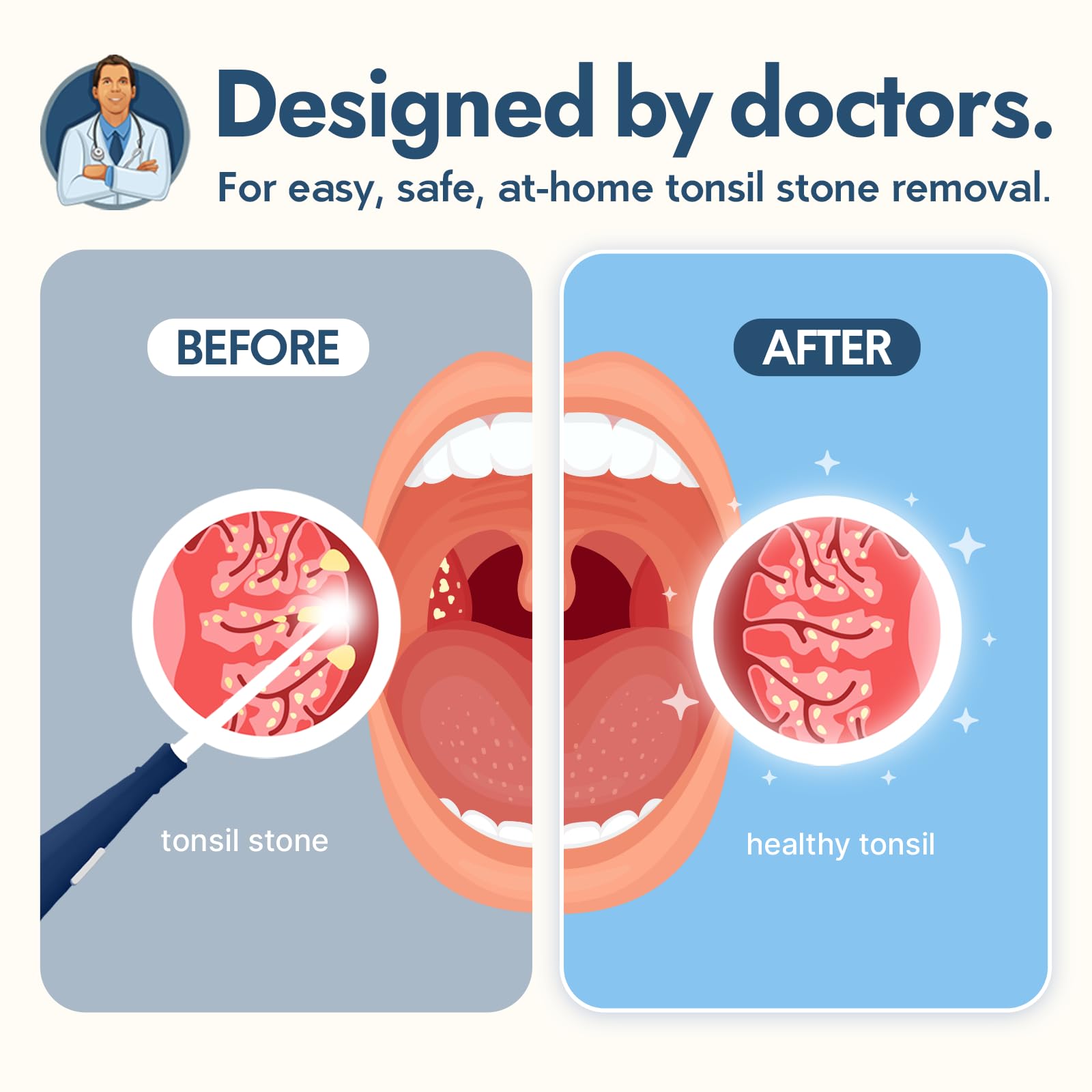 Dr. Frederick’s Original Easy Tonsil Stone Remover Kit - Fast Painless ...