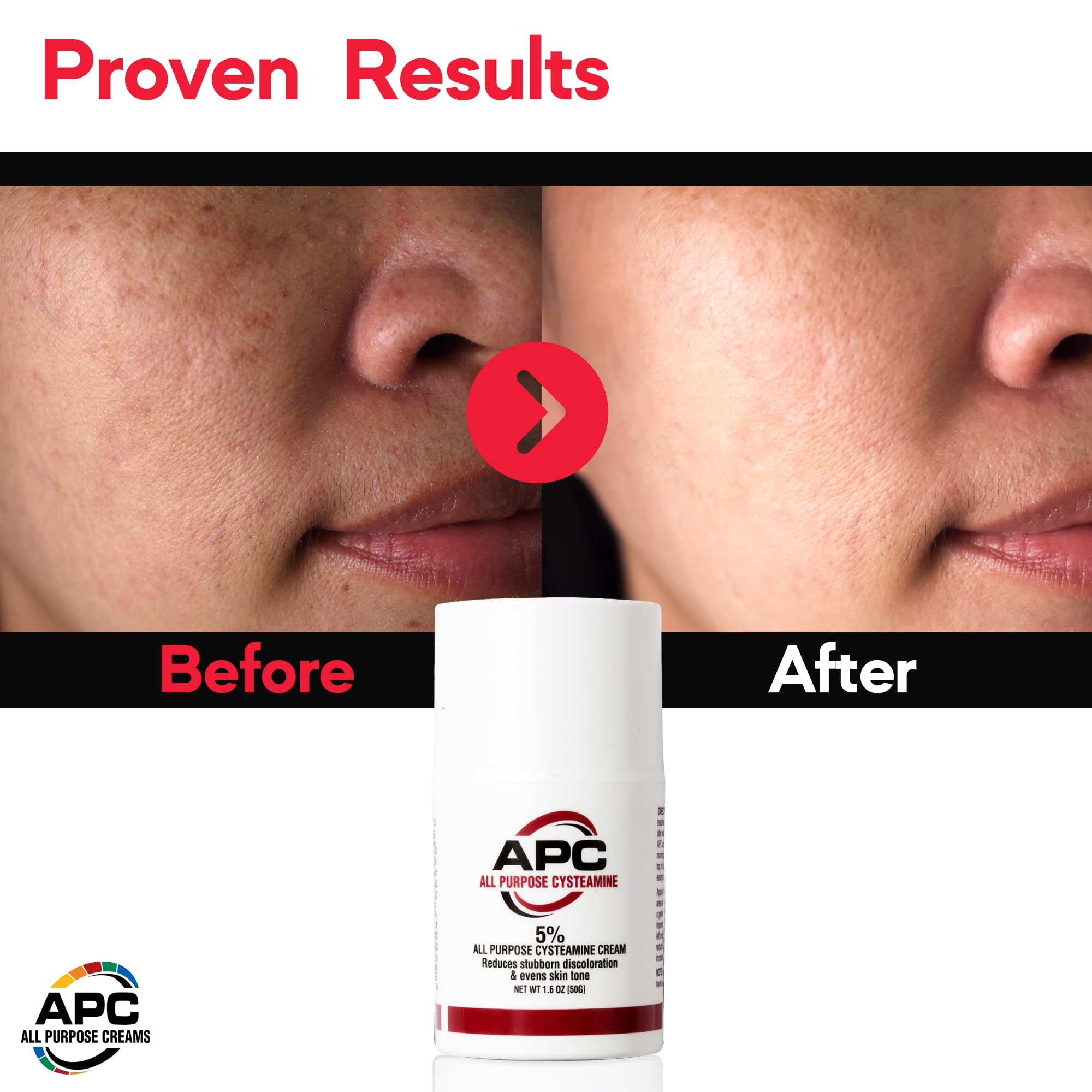 Mua 5% Cysteamine Cream - 50ml Spot Correction Cream for Melasma ...