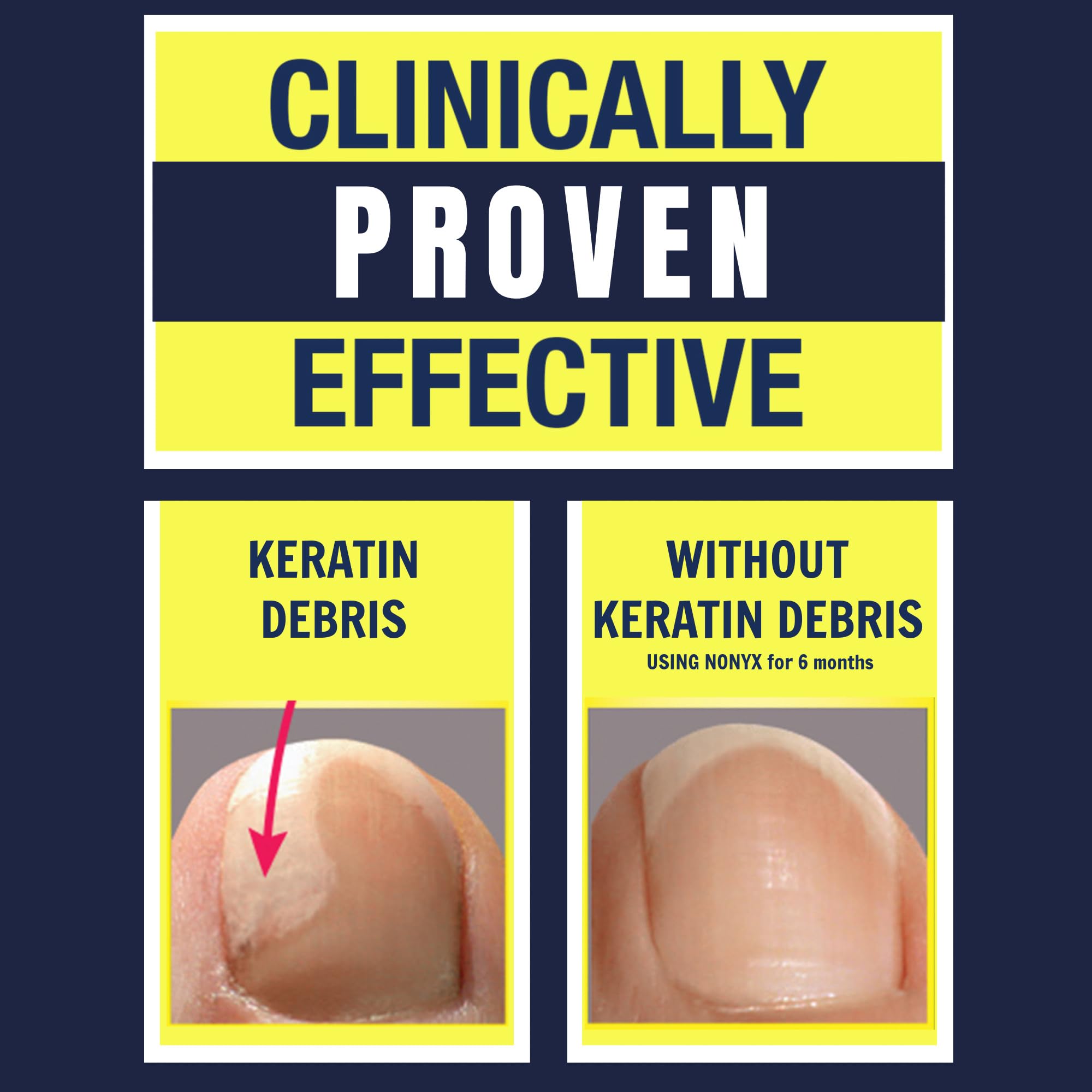 Mua Fungal Nail Clarifying Gel | Rids Nails of Fungus by Removing ...