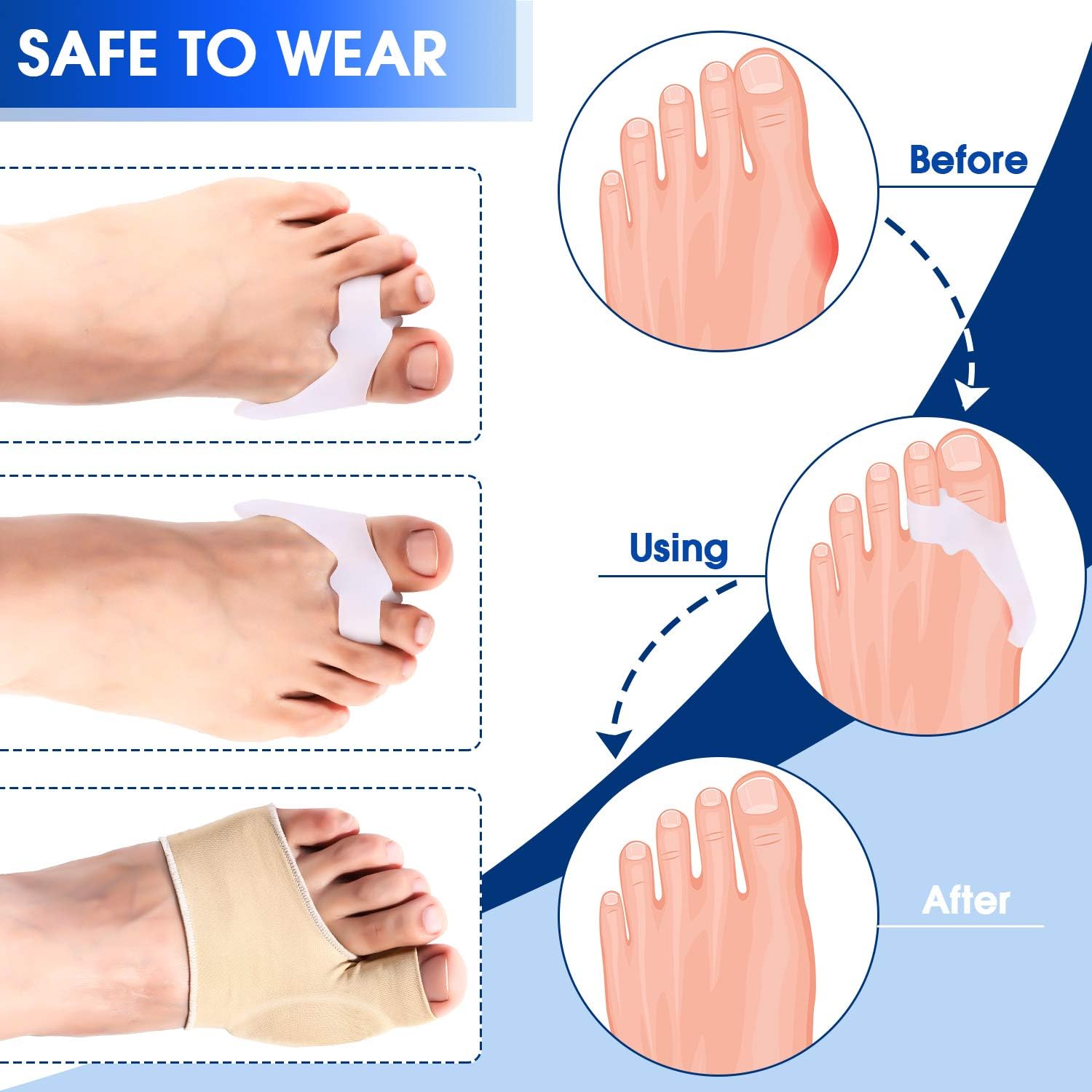 2 Pairs Bunion Relief Sleeve Gel Toe Shields Cushion Pads Bunion Toe ...