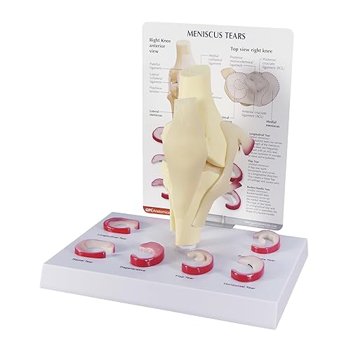 GPI Anatomicals - Human Anatomy Model of Knee Joint with Meniscus Tears ...