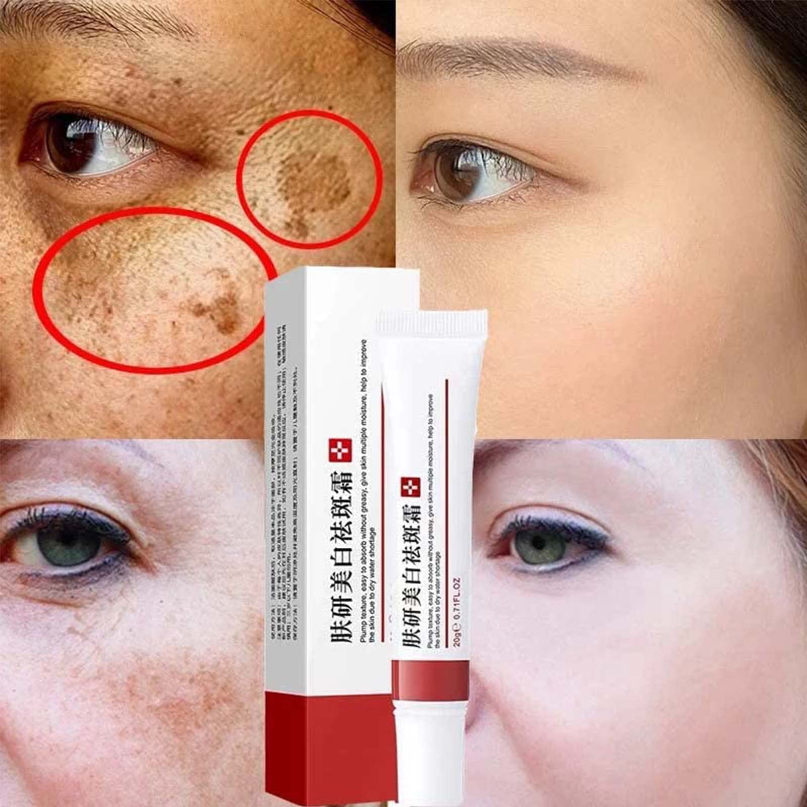 Mua Spot-Off Freckle Whitening Cream, Effective Whitening Freckle Cream, Blemish Recovery Cream ...