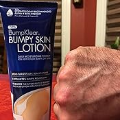 Amazon.com: BumpKlear Bumpy Skin Lotion - Rich Moisturizing Cream for ...