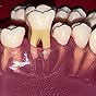 Amazon.com: Dental Implant Teeth Model Study Teach Standard Model with ...