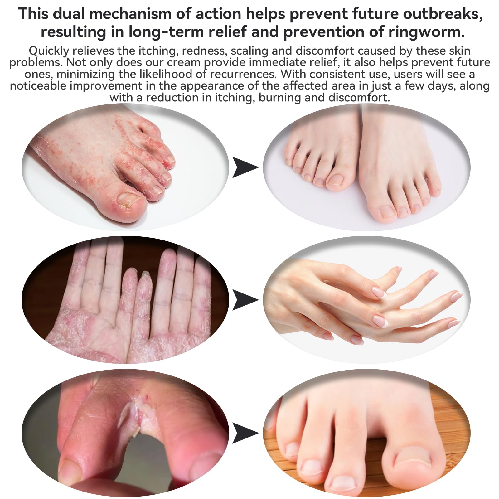 Mua 1 PCS Manuka Honey Tea Tree Drawing Salve Cream Ointment for Boil ...