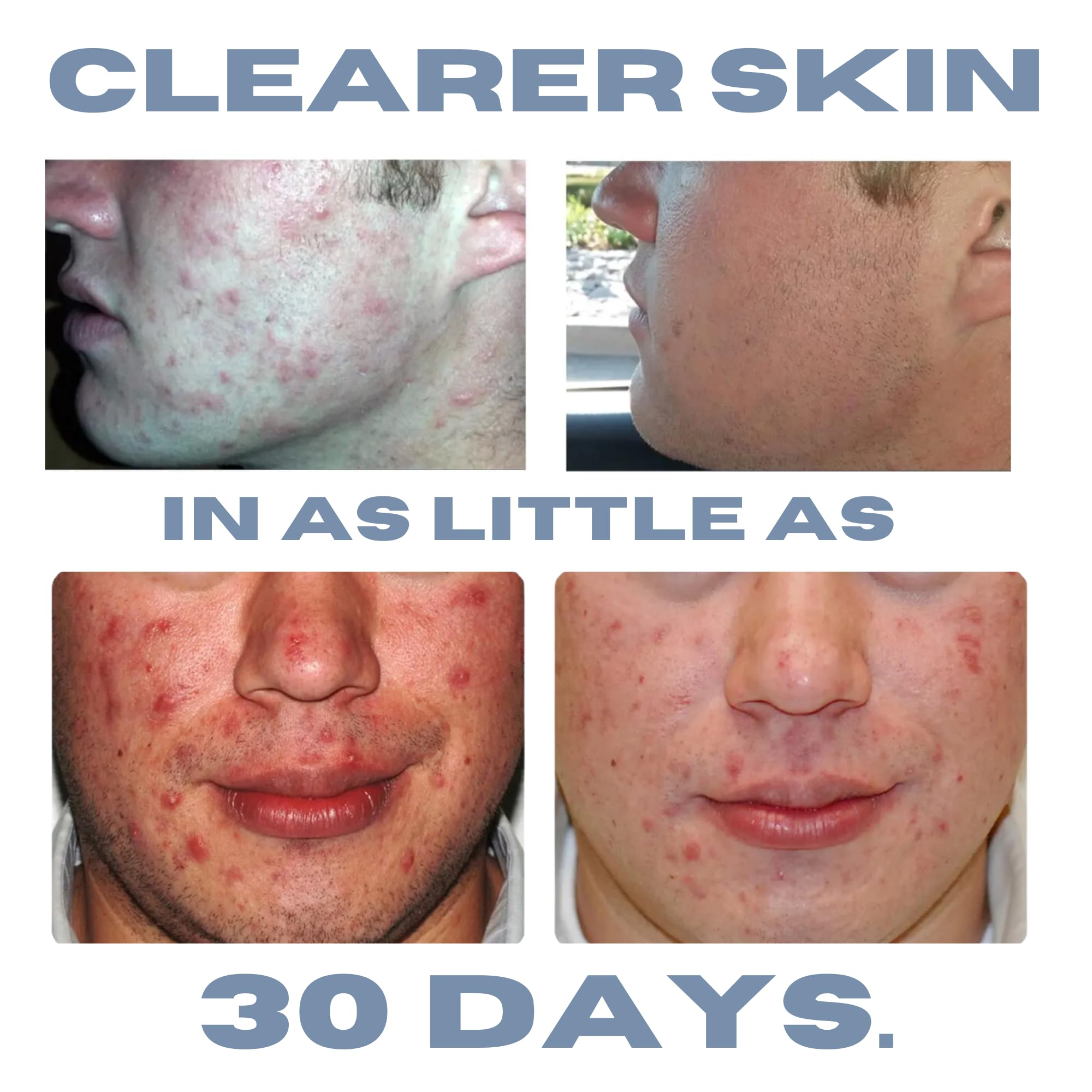 Mua Clearogen Hormonal Acne Solution Natural Anti-DHT Ingredients ...