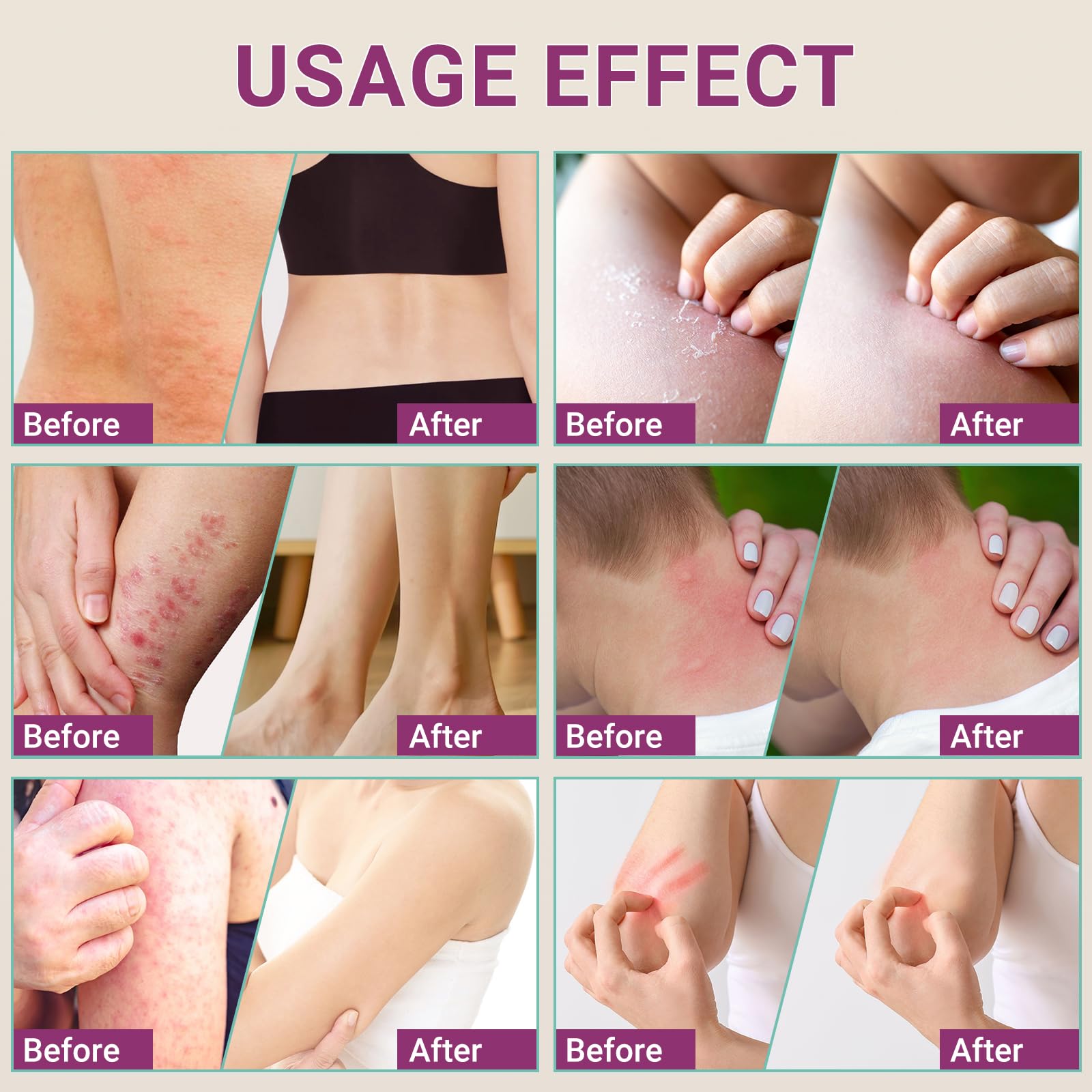 Mua Anti Itch Cream, Extra Strength Anti-Itch Ointment, Relieves Rashes ...