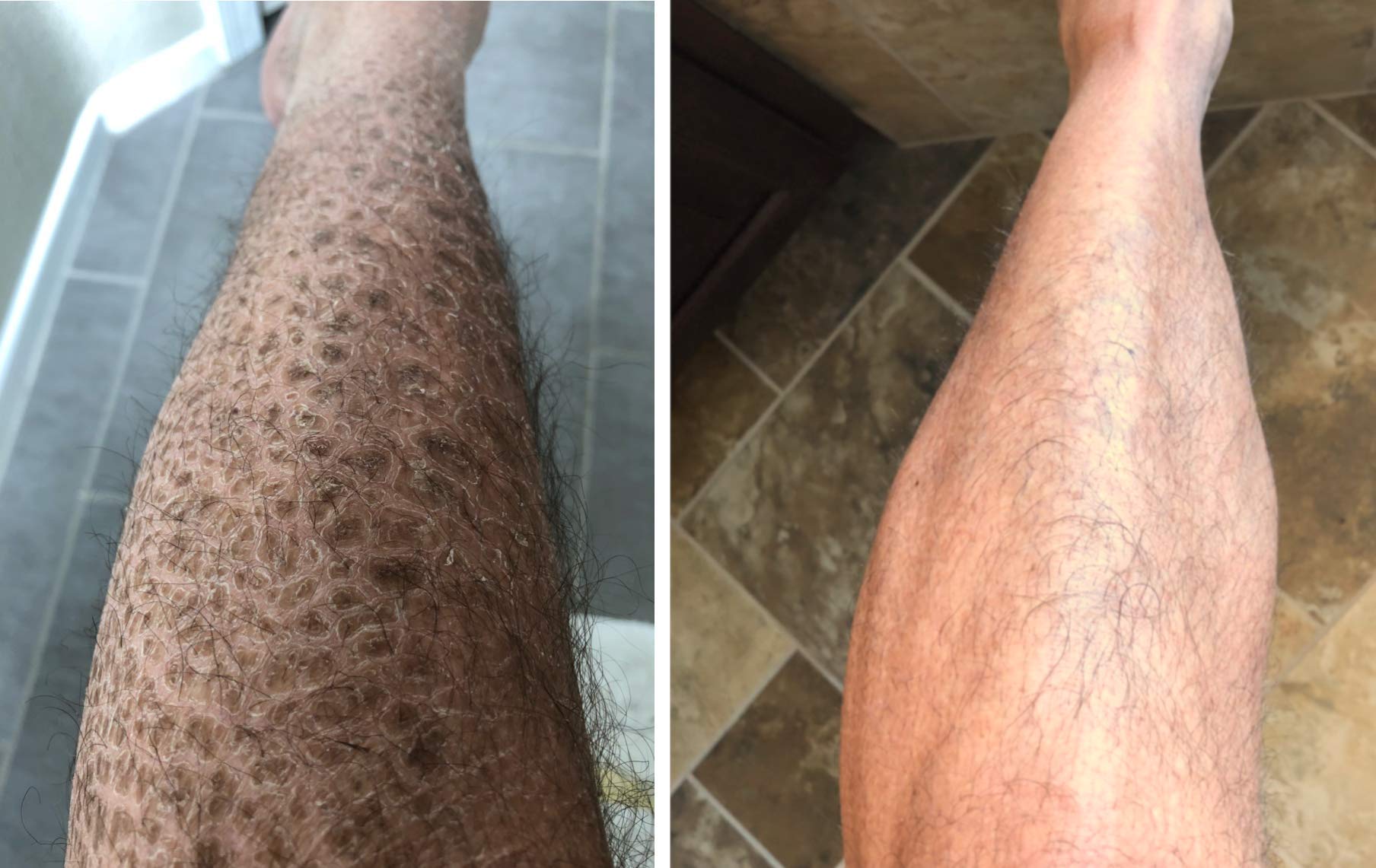 Galleon - G16 Skin Repair Lotion, Excellent Ichthyosis Treatment Cream ...