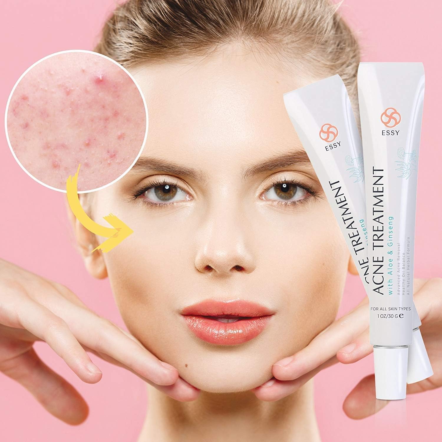 Acne Cream with Aloe and Ginseng – Advanced Acne Removal Healthy Oil ...