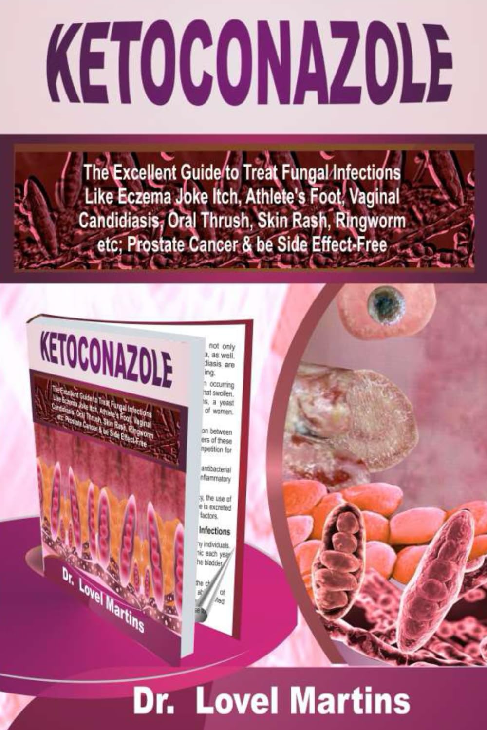 Mua KETOCONAZOLE: The Excellent Guide to Treat Fungal Infections Like ...