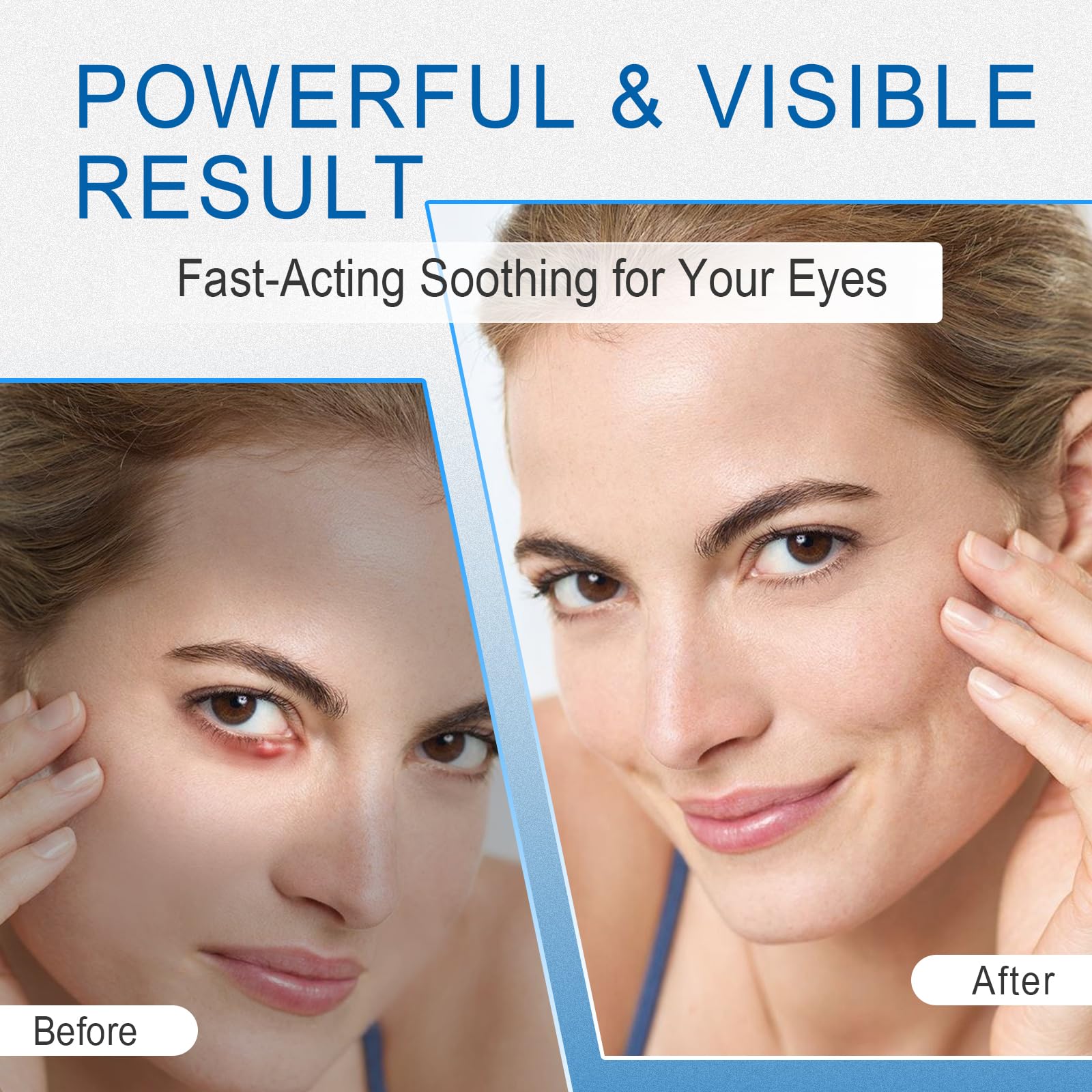 Mua Stye Eye Treatment, Eye Stye Remover Drops, Gentle Relief for ...