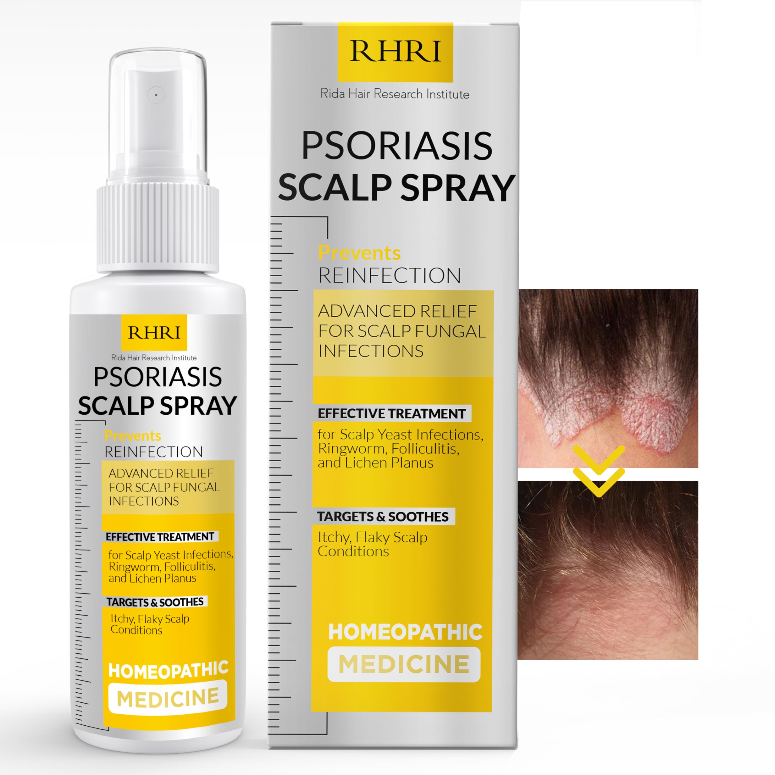 Mua Psoriasis Scalp Treatment Spray – Anti-Itch, Anti-Fungal Scalp ...