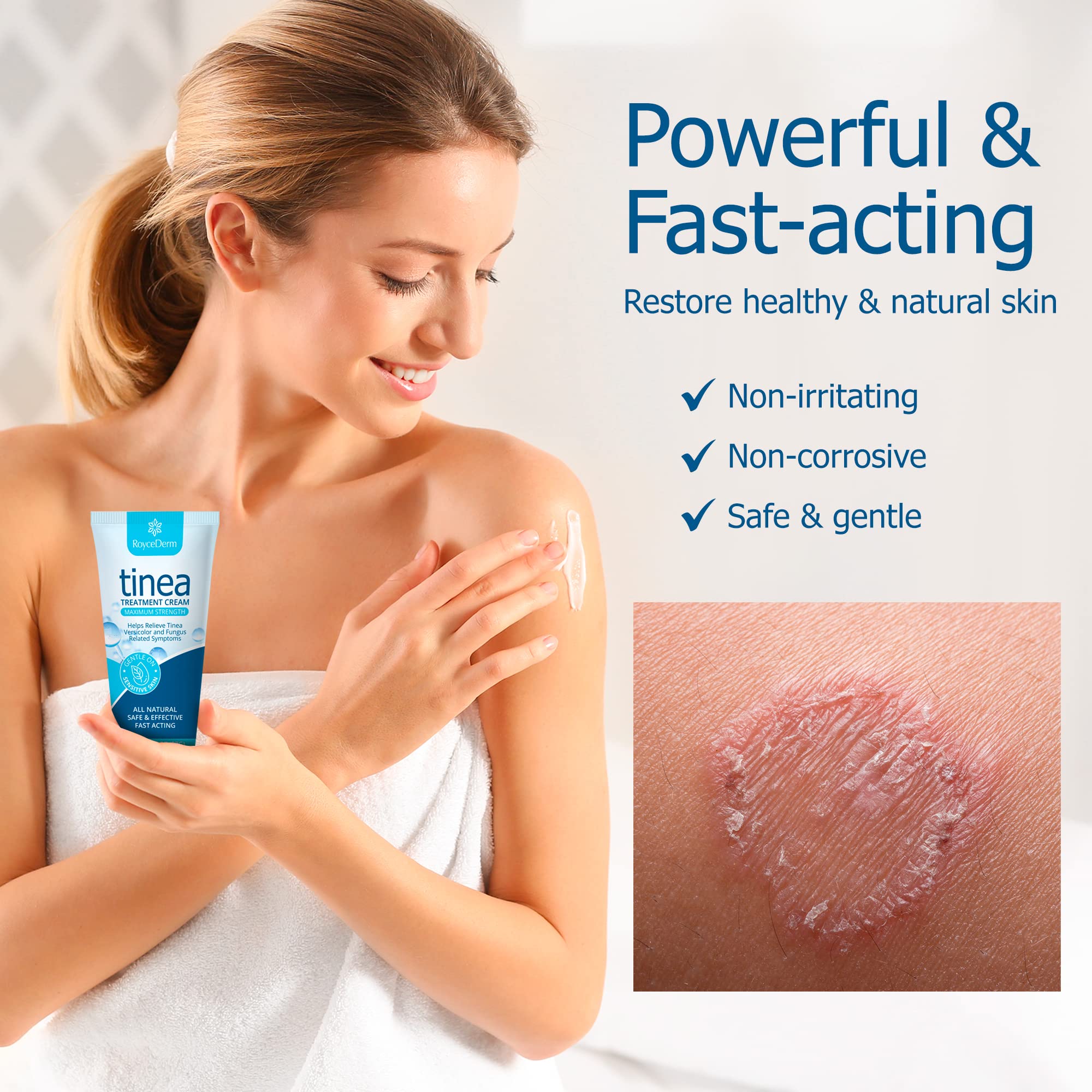 Mua Roycederm Tinea Versicolor Treatment, Athletes Foot Treatment ...