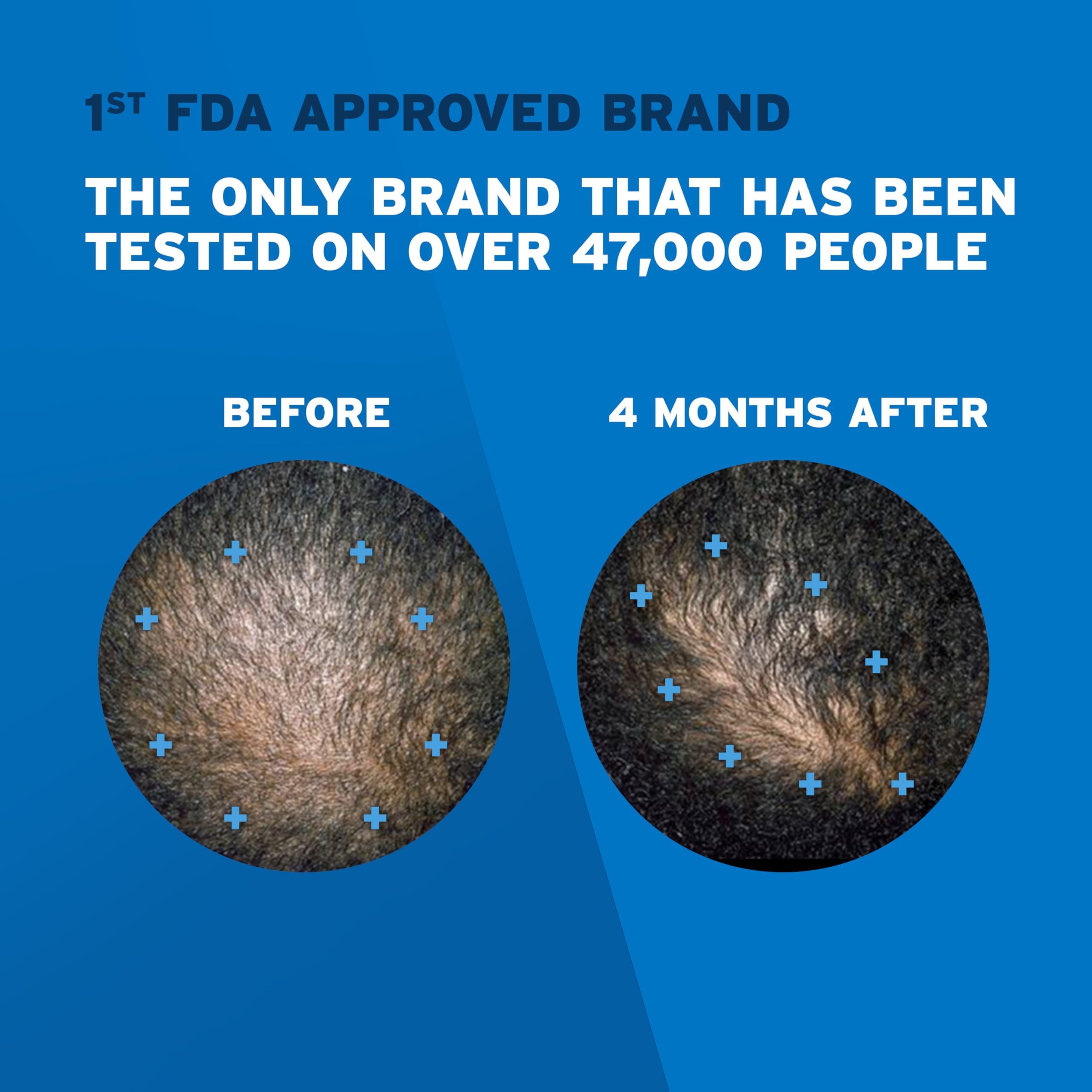 Mua Men's Rogaine 5% Minoxidil Topical Aerosol Hair Regrowth Treatment ...