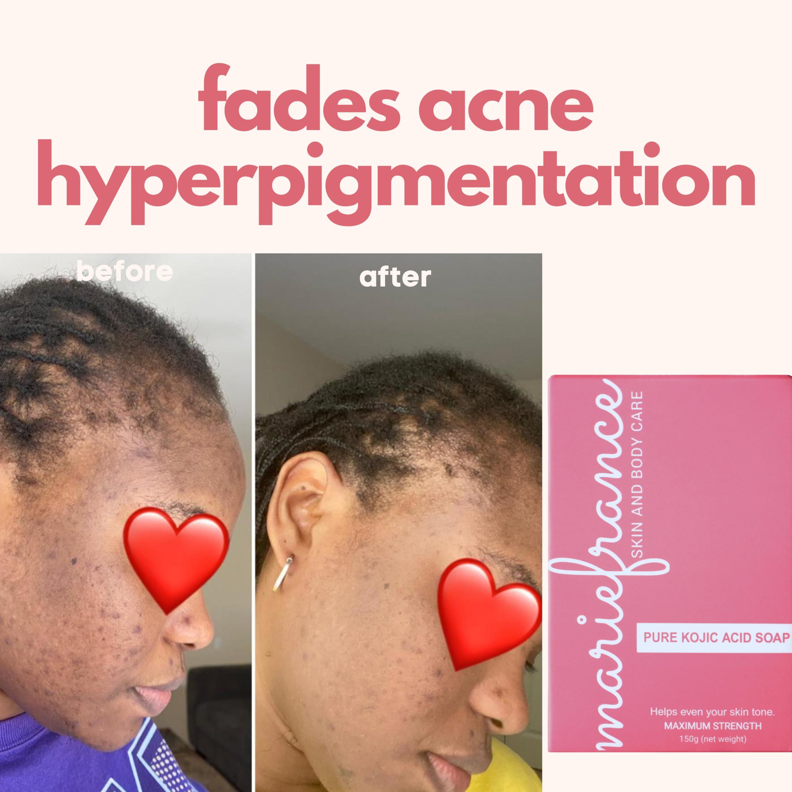 Mua Pure Kojic Acid Soap for Hyperpigmentation, Dark Spots & Skin ...