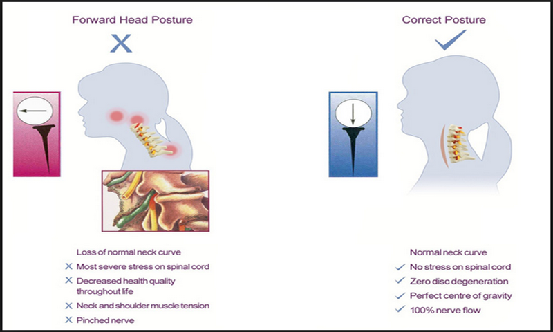Forward Head Posture:Amazon.fr:Appstore for Android