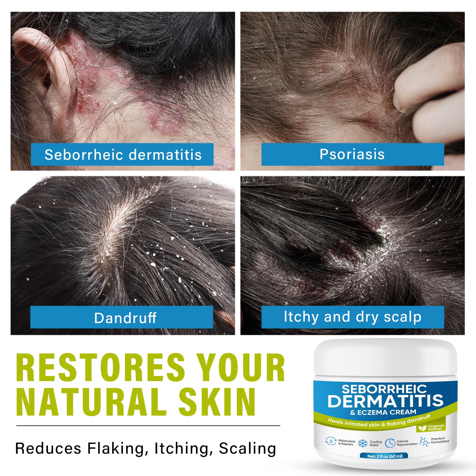 Seborrheic Dermatitis Cream, Fast Acting Seborrheic Dermatitis Scalp ...