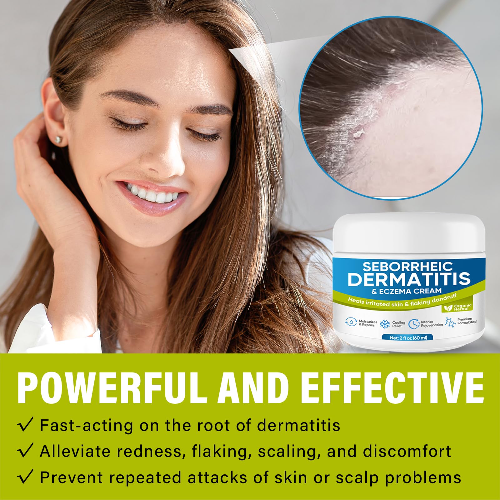 Seborrheic Dermatitis Cream, Fast Acting Seborrheic Dermatitis Scalp ...