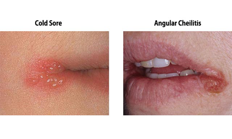 Angular Cheilitis Free Forever Review:Amazon.com:Appstore for Android