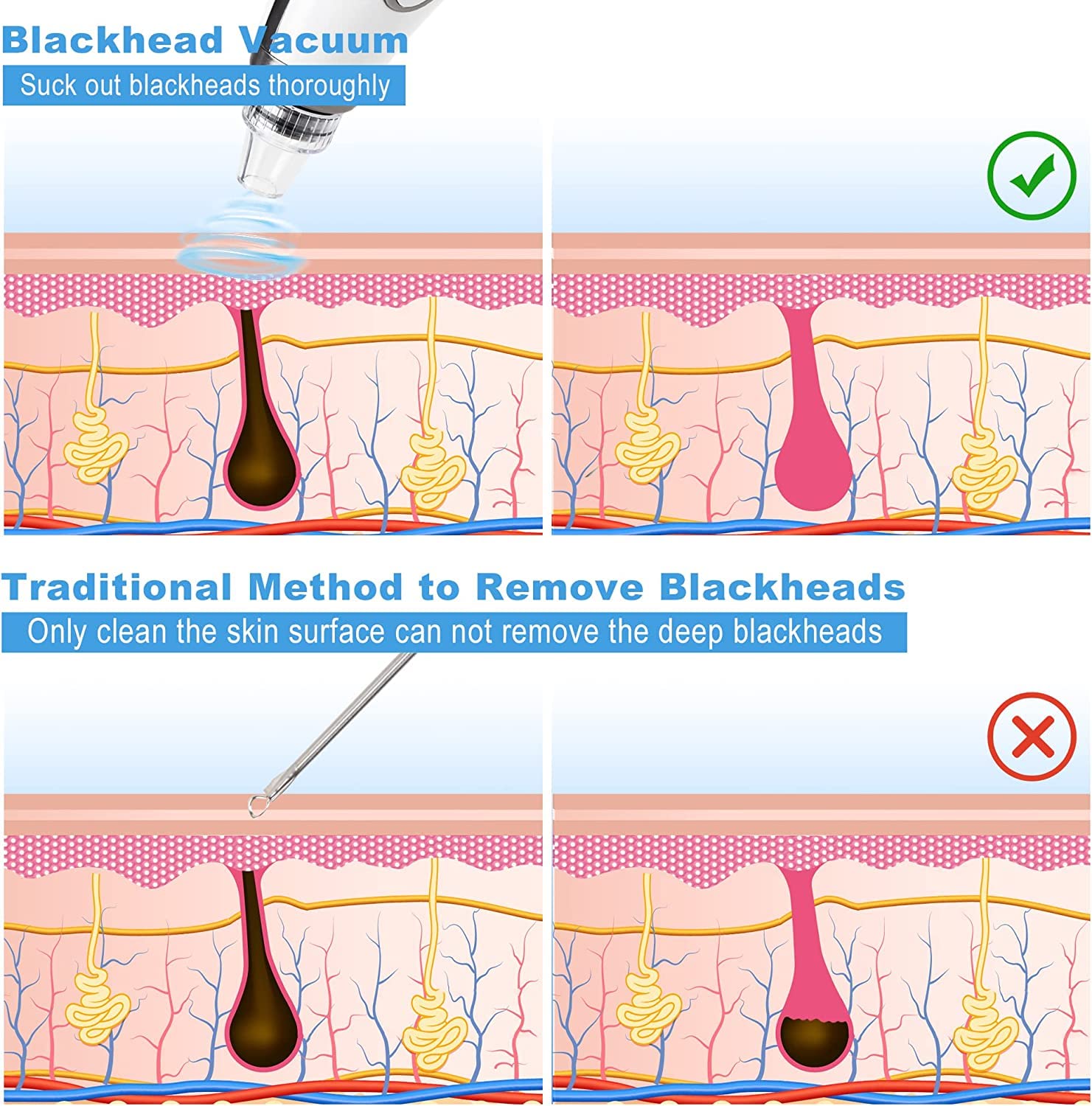 Mua Tibobo Blackhead Remover Tools Pore Vacuum, Blackhead Remover Kit ...
