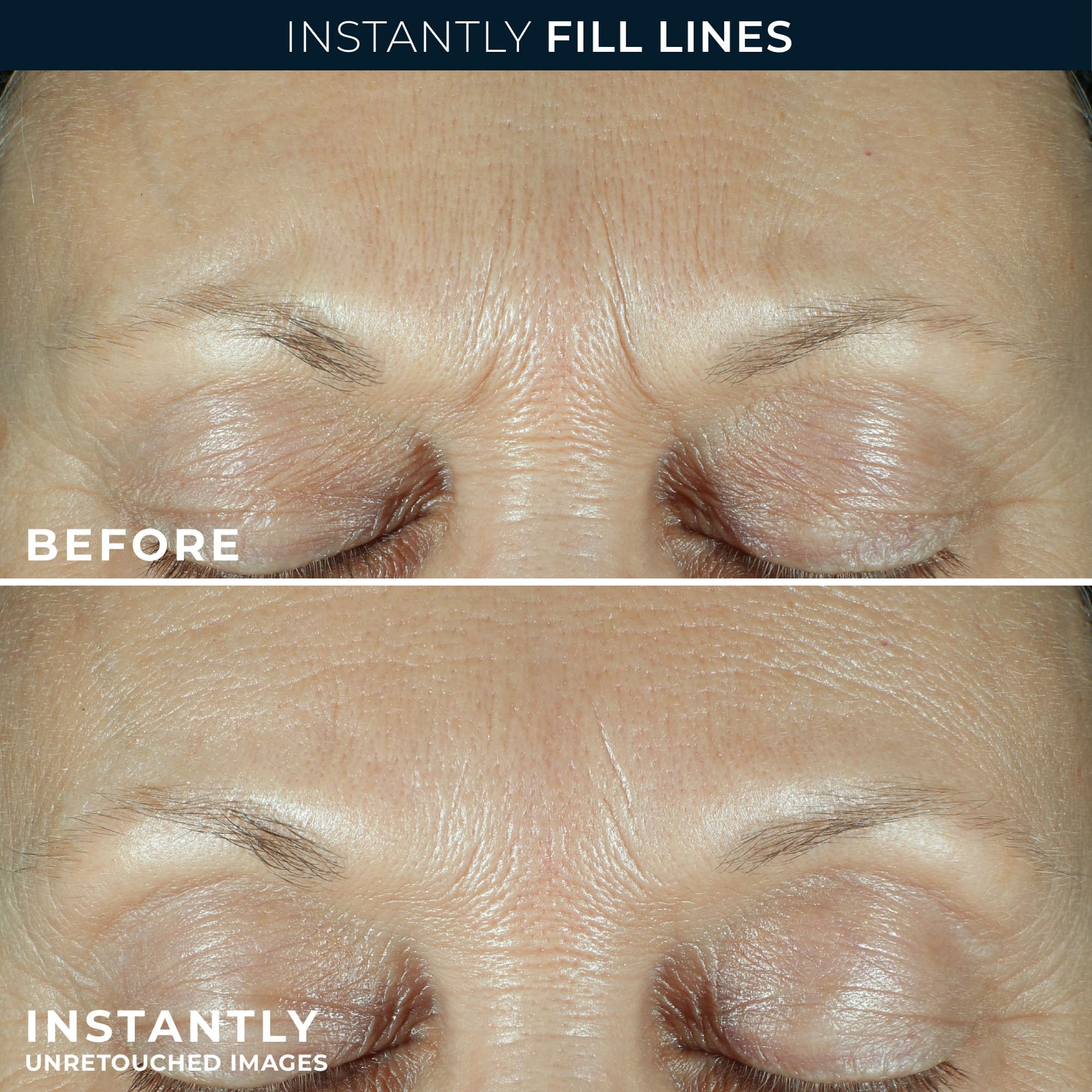 Mua RoC Derm Correxion Fill + Treat Advanced Retinol Serum, Wrinkle ...