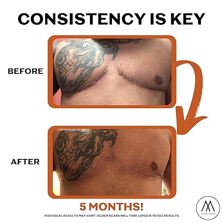 Mua Motivo Scar Tape - 200” x 1” Roll (20 Strips) | Water and Sweat ...