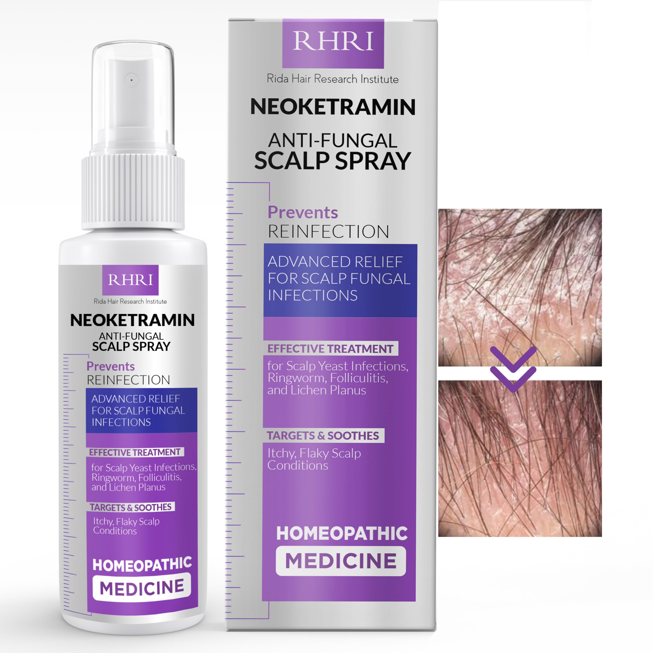 Mua Anti Fungal Scalp Spray for Flaky, Itchy Scalp Relief | Antifungal ...