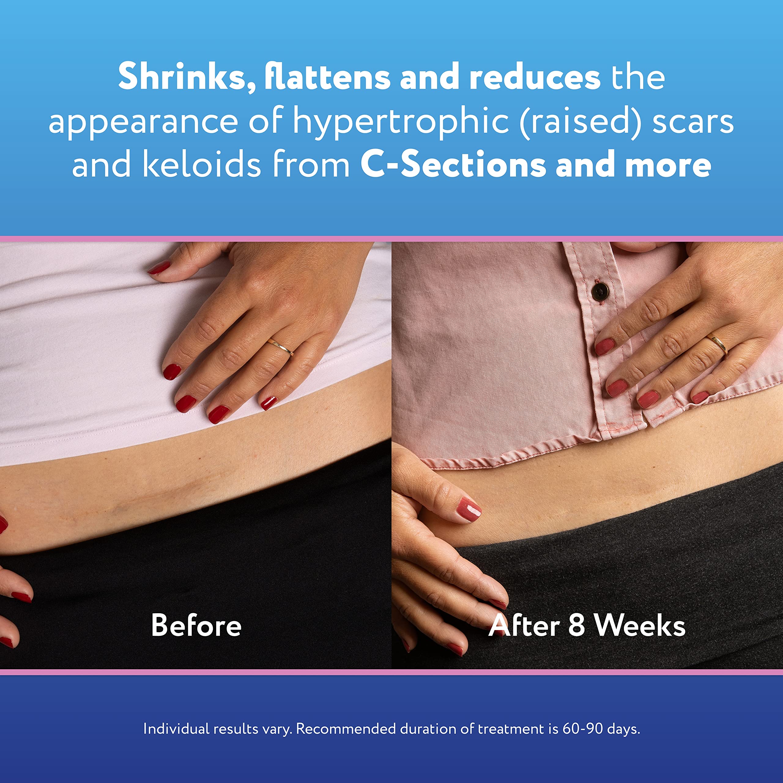 Mua ScarAway Advanced Silicone Scar Sheets for C-Section, Reusable ...