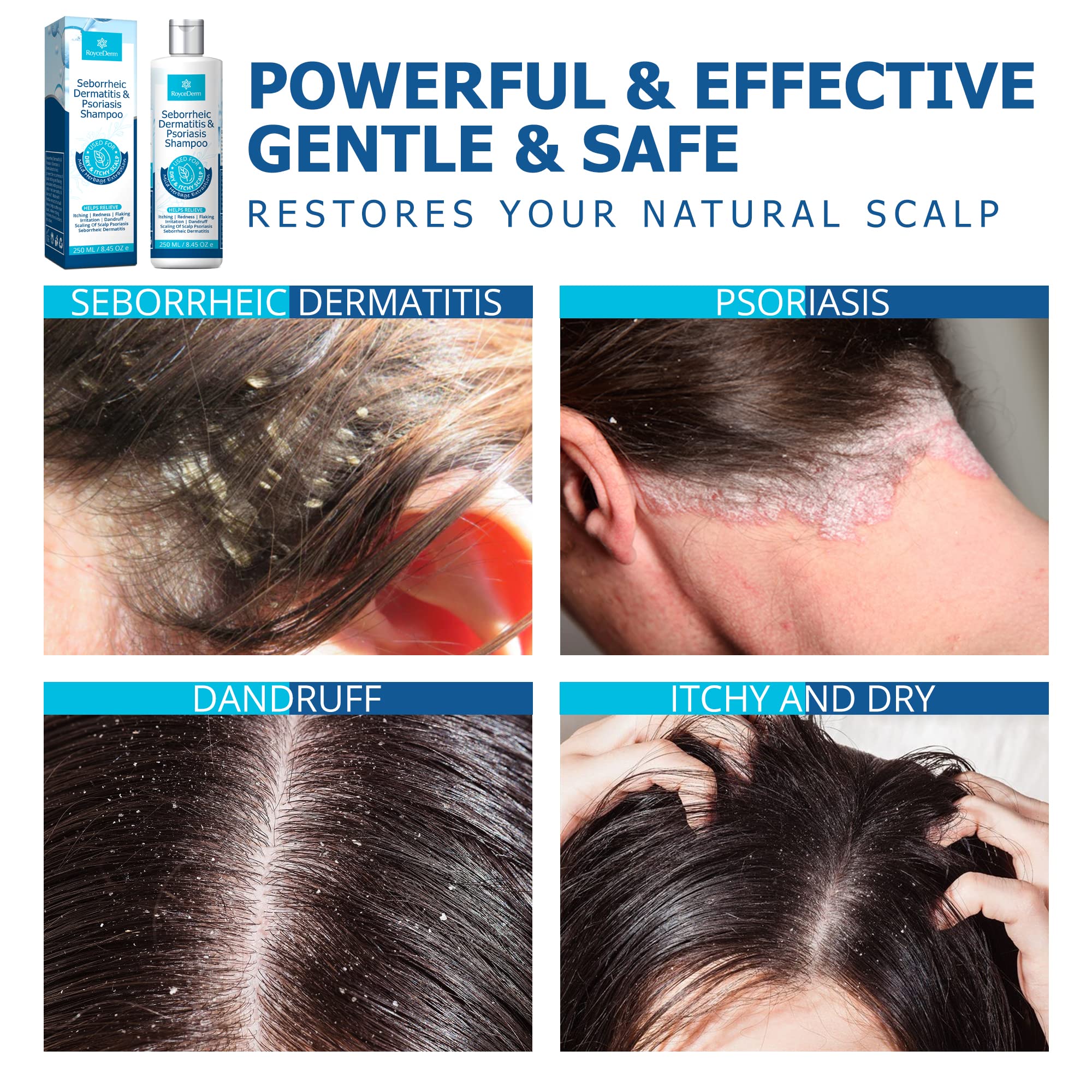 Mua Roycederm Psoriasis Shampoo, Seborrheic Dermatitis Shampoo, Folliculitis Shampoo, Dandruff ...