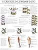 Herniated Lumbar Disk - Quick Reference Chart: Full illustrated in Oman ...
