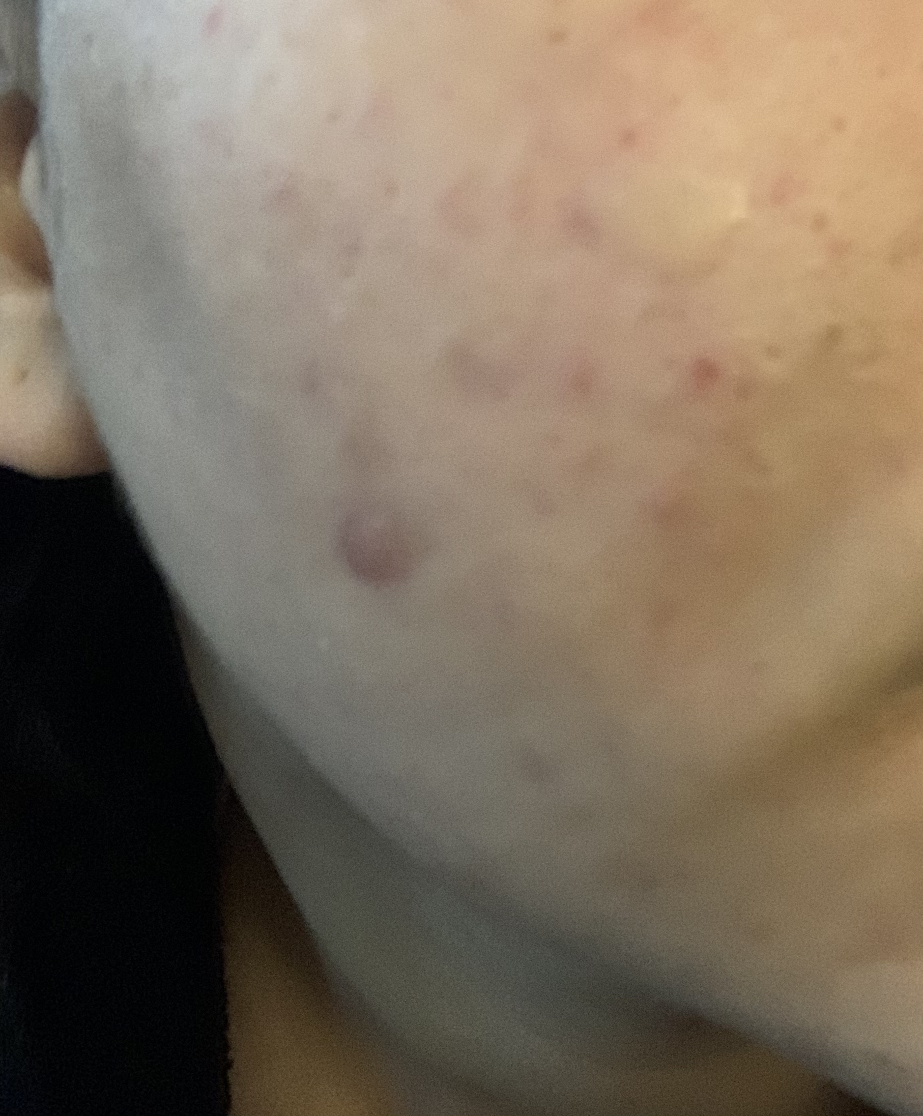 $11/mo - Finance Dermaflage Scar Filler Kit - Medium - Deep Scar Cover ...