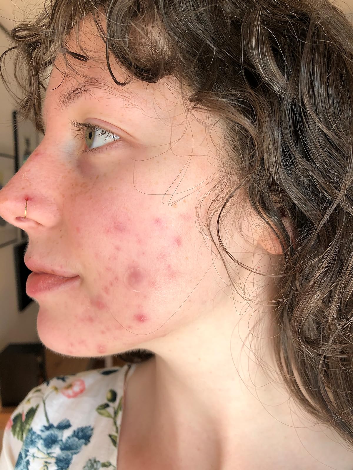 Made my acne marks fade!!