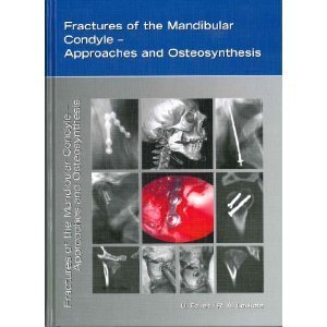 Fractures of the Mandibular Condyle - Approaches and Osteosynthesis by ...