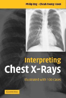 Interpreting Chest X-Rays: Illustrated with 100 Cases by Philip Eng ...