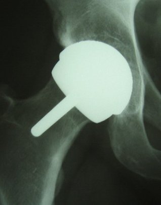 Hip Replacement Using The Birmingham Hip Resurfacing Procedure: My ...