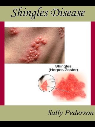 Shingles Disease - The Complete Guide - Everything you need to know ...