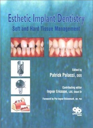 Esthetic Implant Dentistry: Soft & Hard Tissue by Patrick Palacci ...