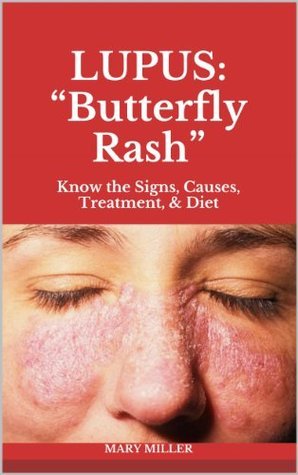 LUPUS: “Butterfly Rash”: Know the Signs, Causes, Treatment, & Diet by ...