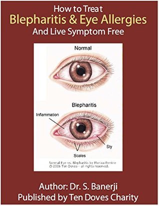 How to treat Blepharitis and Eye Allergies and live symptom free ...