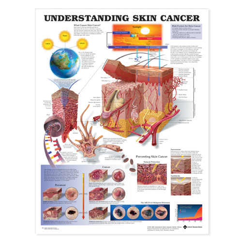 Understanding Skin Cancer Anatomical Chart by Anatomical Chart Company ...