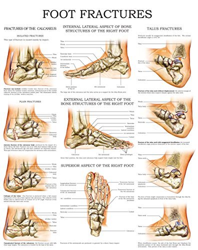 Foot fractures - Quick Reference Chart: Full illustrated by HC ...